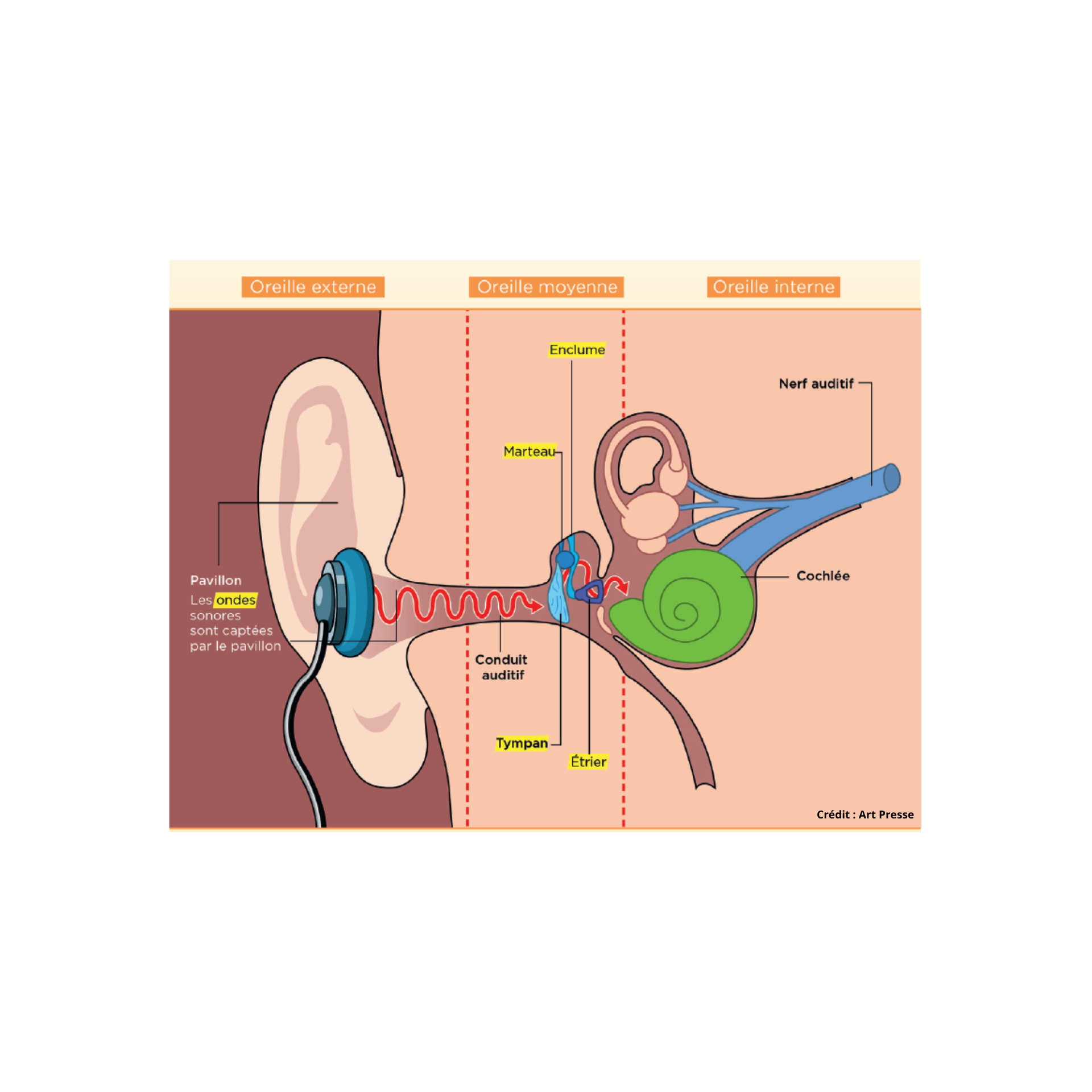 Otite séromuqueuse ou séreuse : tout comprendre | Fondation pour l'audition